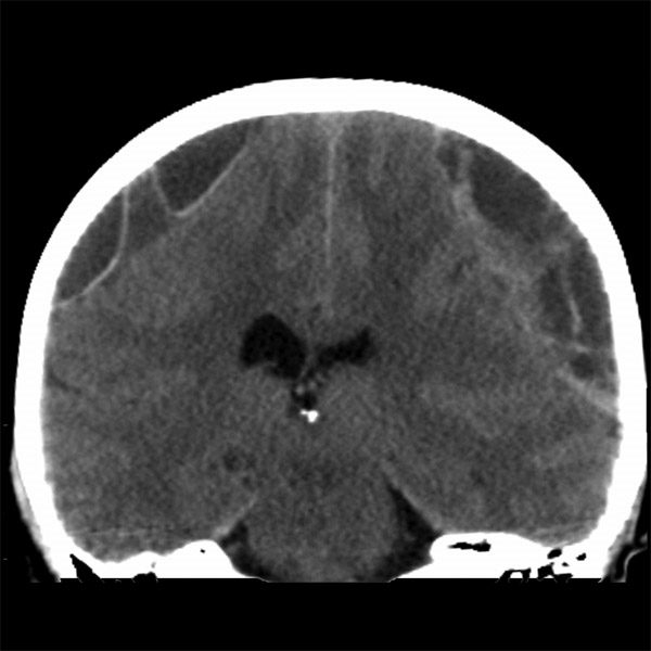 Emorragia Subdurale – Test Ammissione