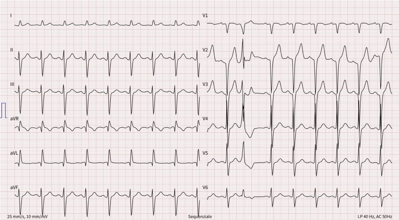 Simulazione Pro 023C (40 ECG)