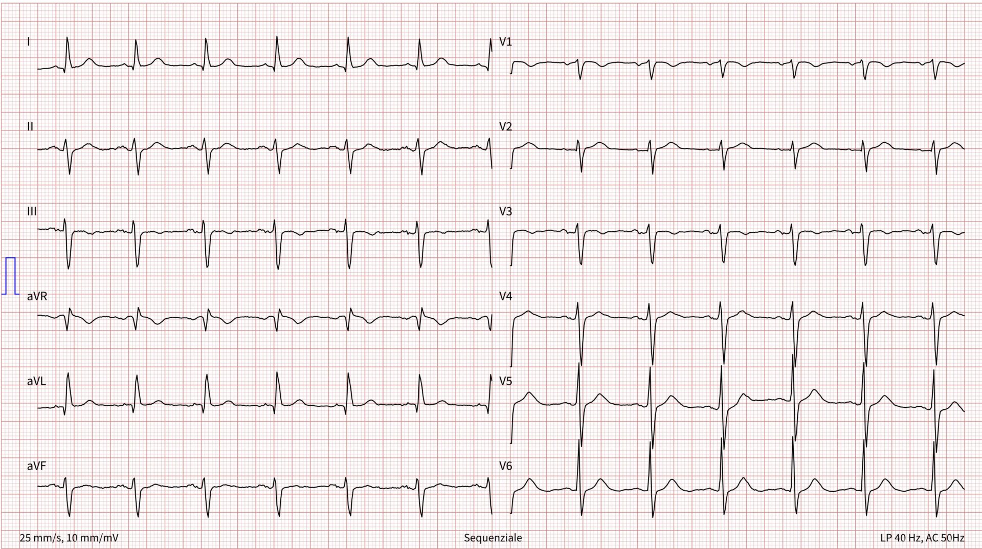 Simulazione Pro 023C (40 ECG)