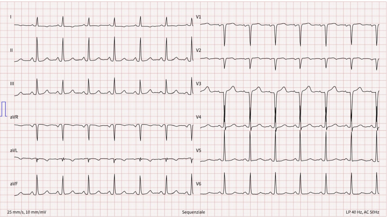 Simulazione Pro 023C (40 ECG)