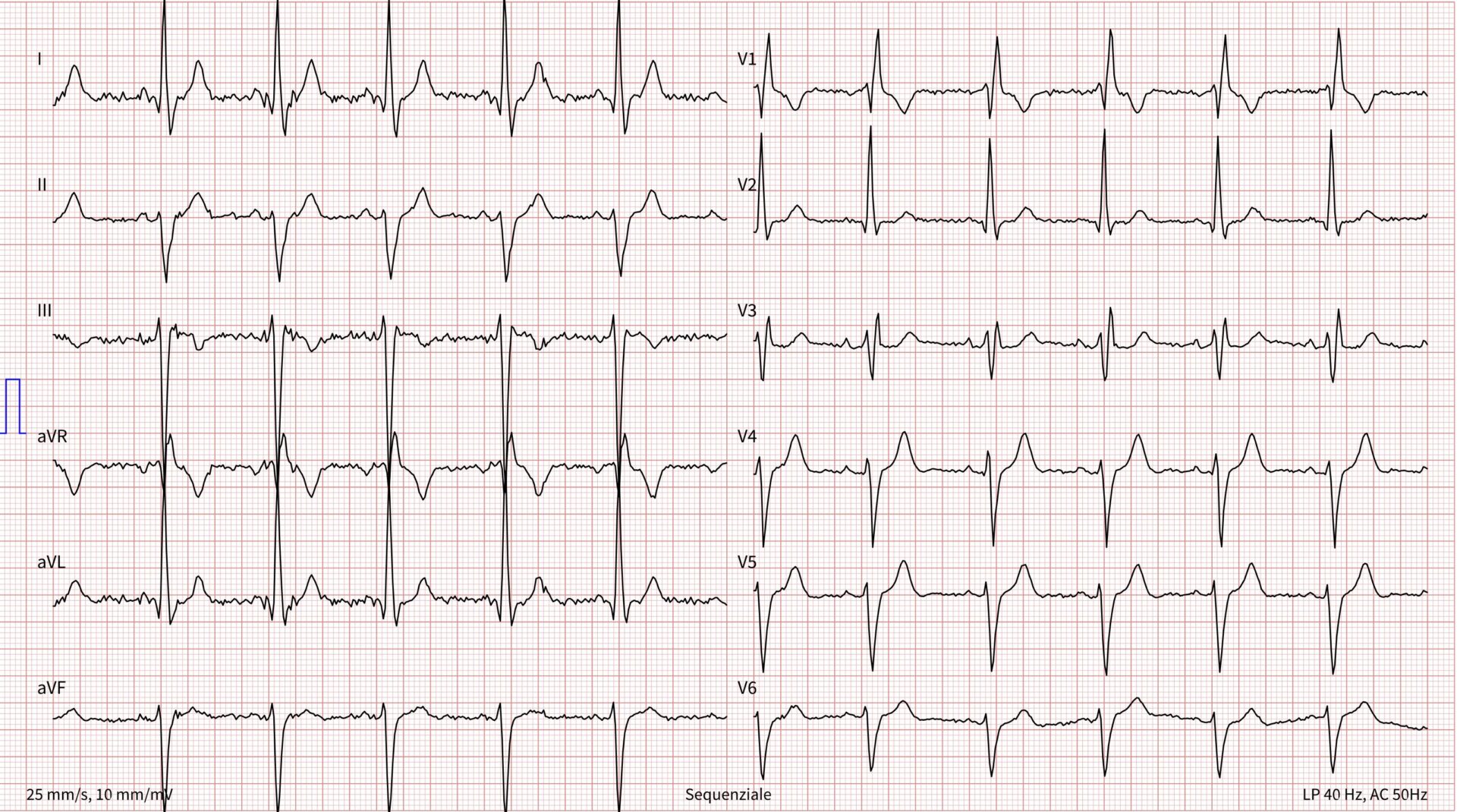 Simulazione Pro 023C (40 ECG)