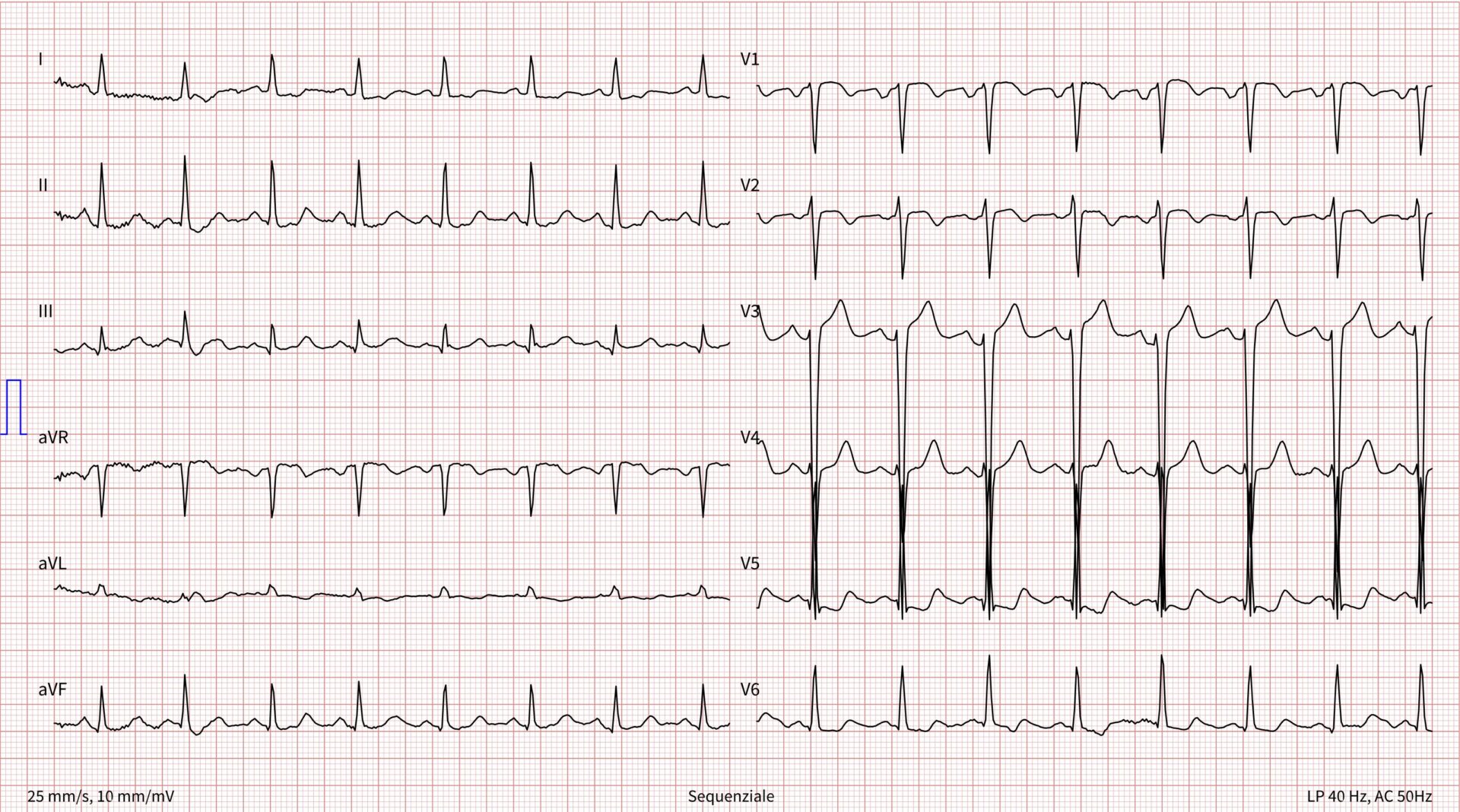 Simulazione Pro 023C (40 ECG)