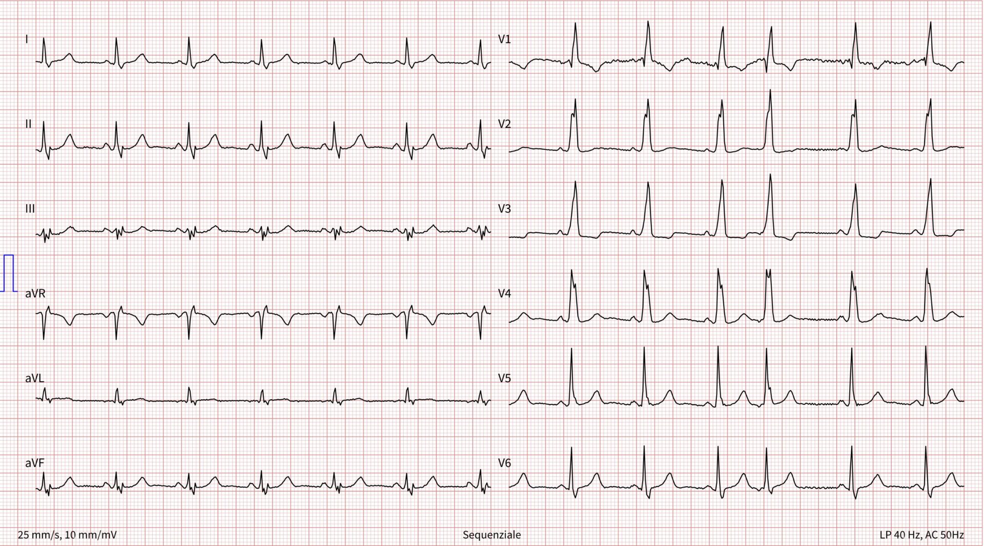 Simulazione Pro 023C (40 ECG)