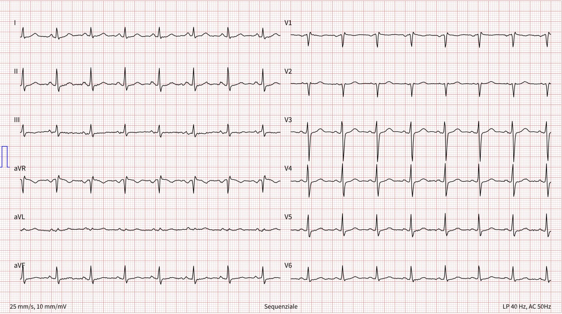 Simulazione Pro 025B (50 ECG)