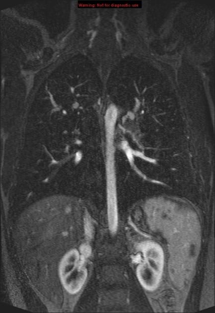 Tromboembolia polmonare