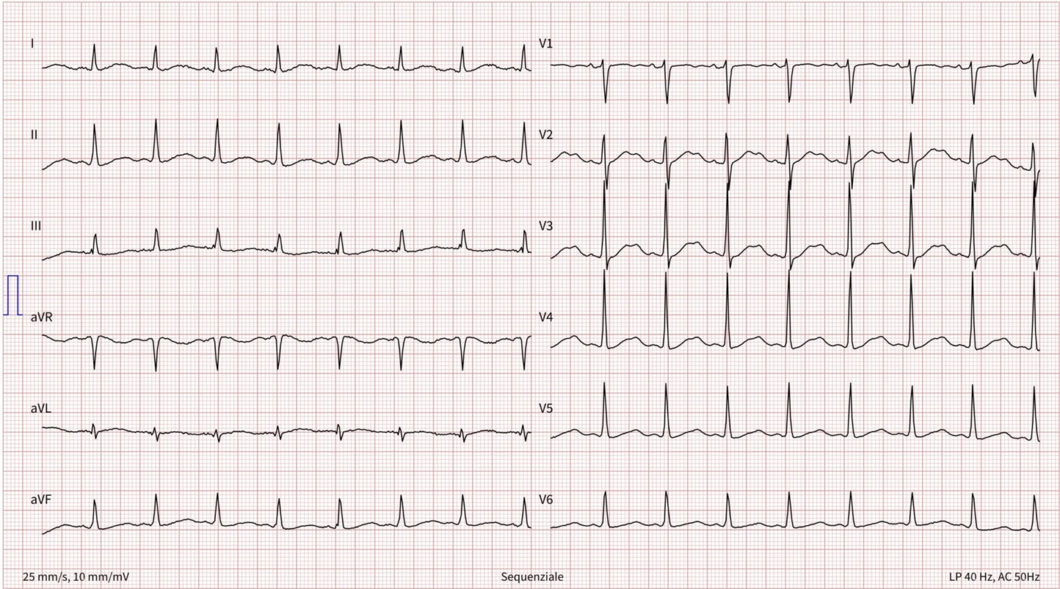 Simulazione Pro 024A (50 ECG)