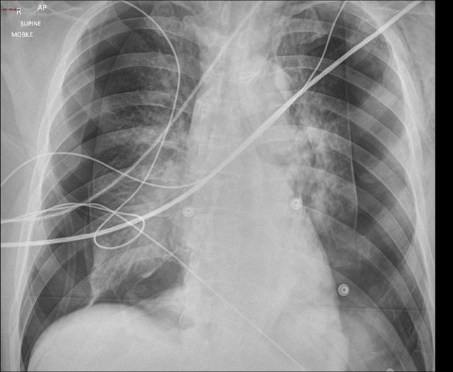 Pneumotorace – Test Ammissione