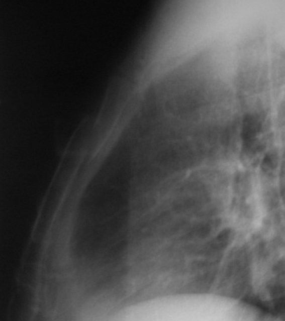 02.45 – Fratture sternali – Test Ammissione