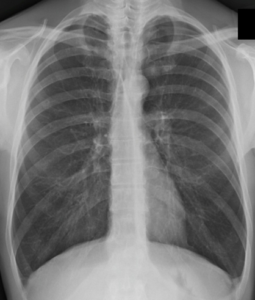 Broncopneumopatia cronica ostruttiva (BPCO)