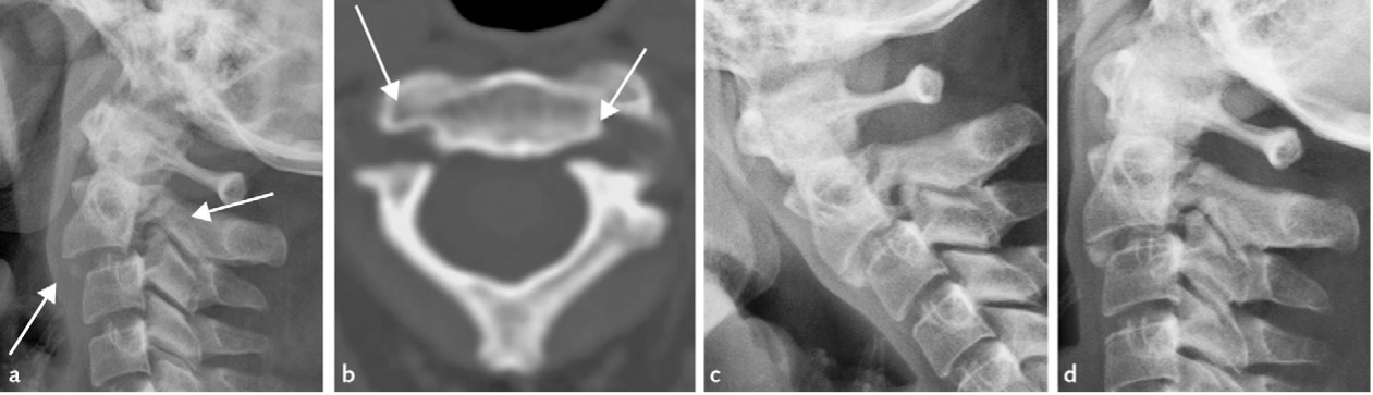 Fratture del rachide cervicale